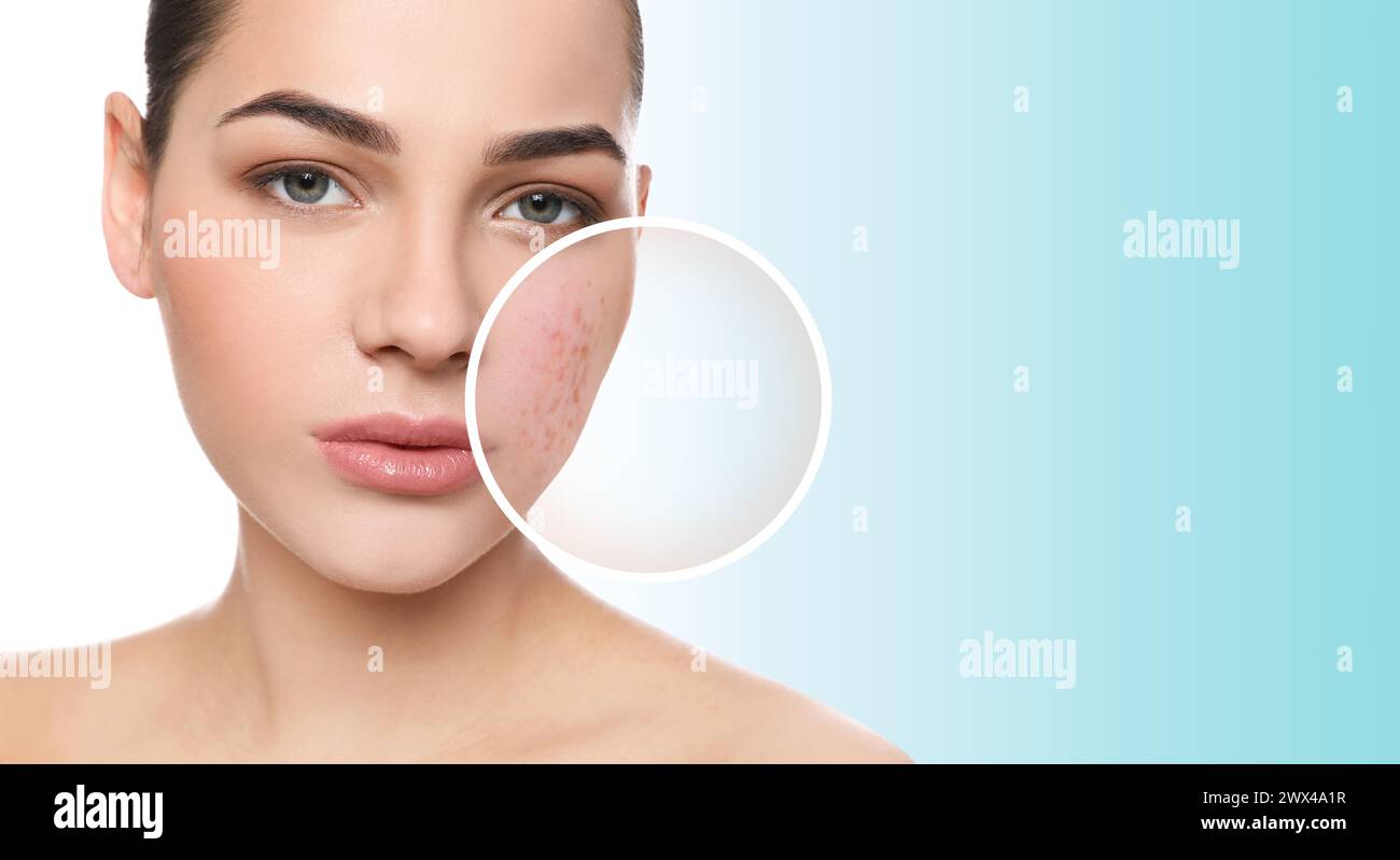 Scar removal banner hi-res stock photography and images - Alamy