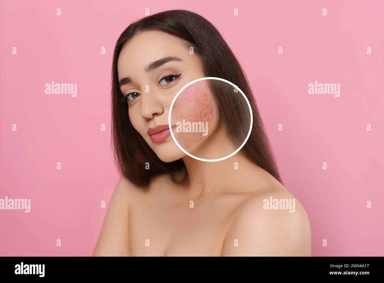 Rosacea face rash hi-res stock photography and images - Alamy