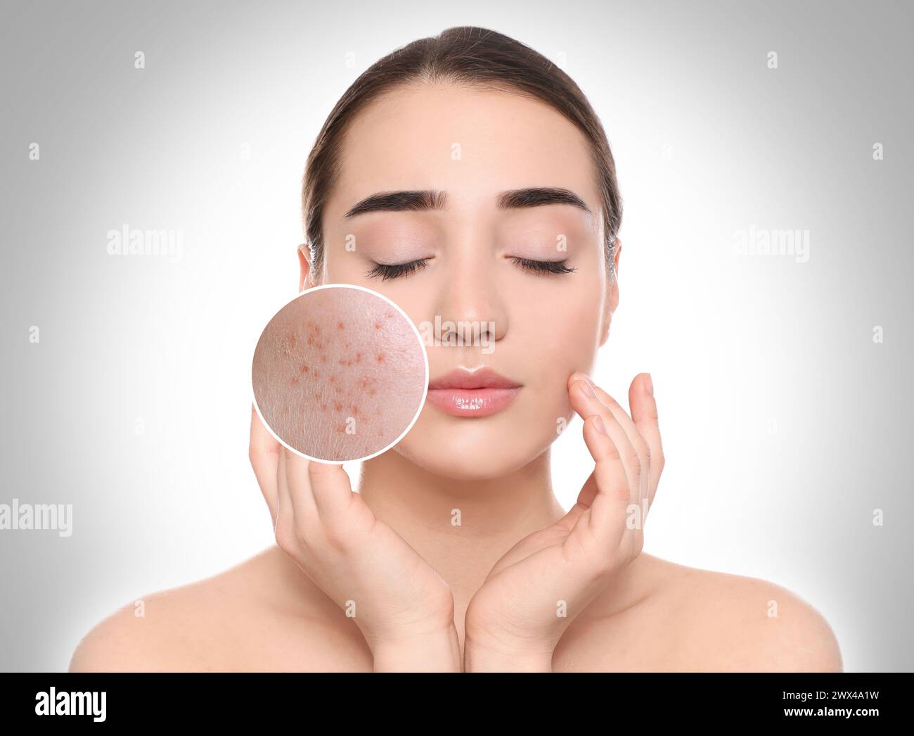 Woman with acne on her face on grey gradient background. Zoomed area ...