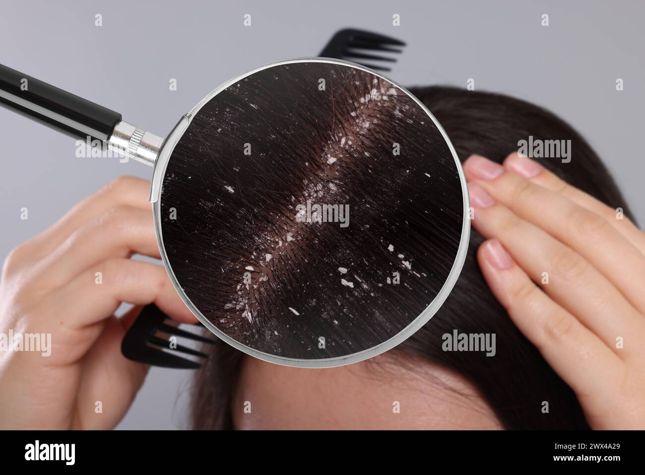 Woman suffering from dandruff on grey background, closeup. View through ...
