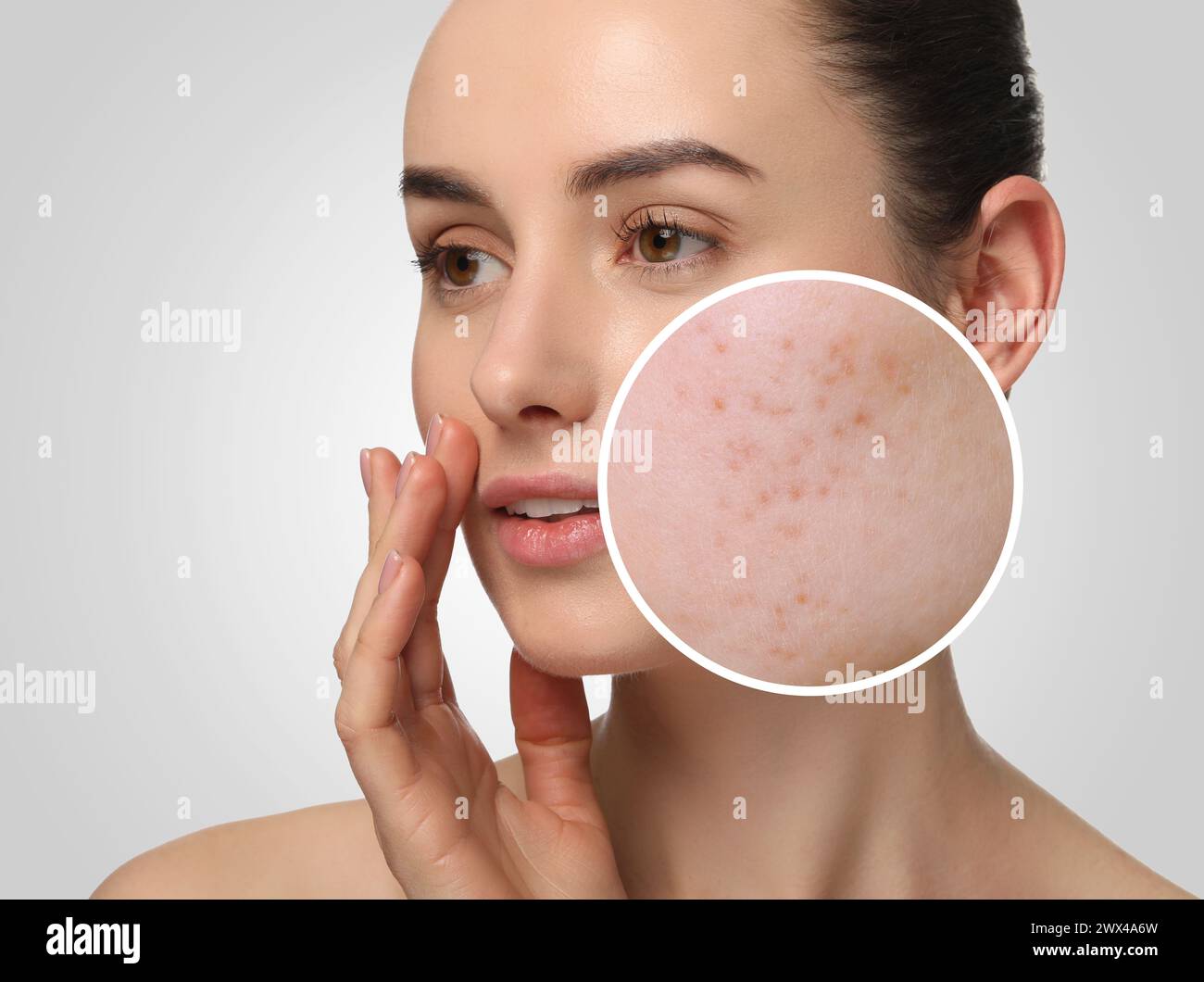 Woman with acne on her face on grey background. Zoomed area showing ...