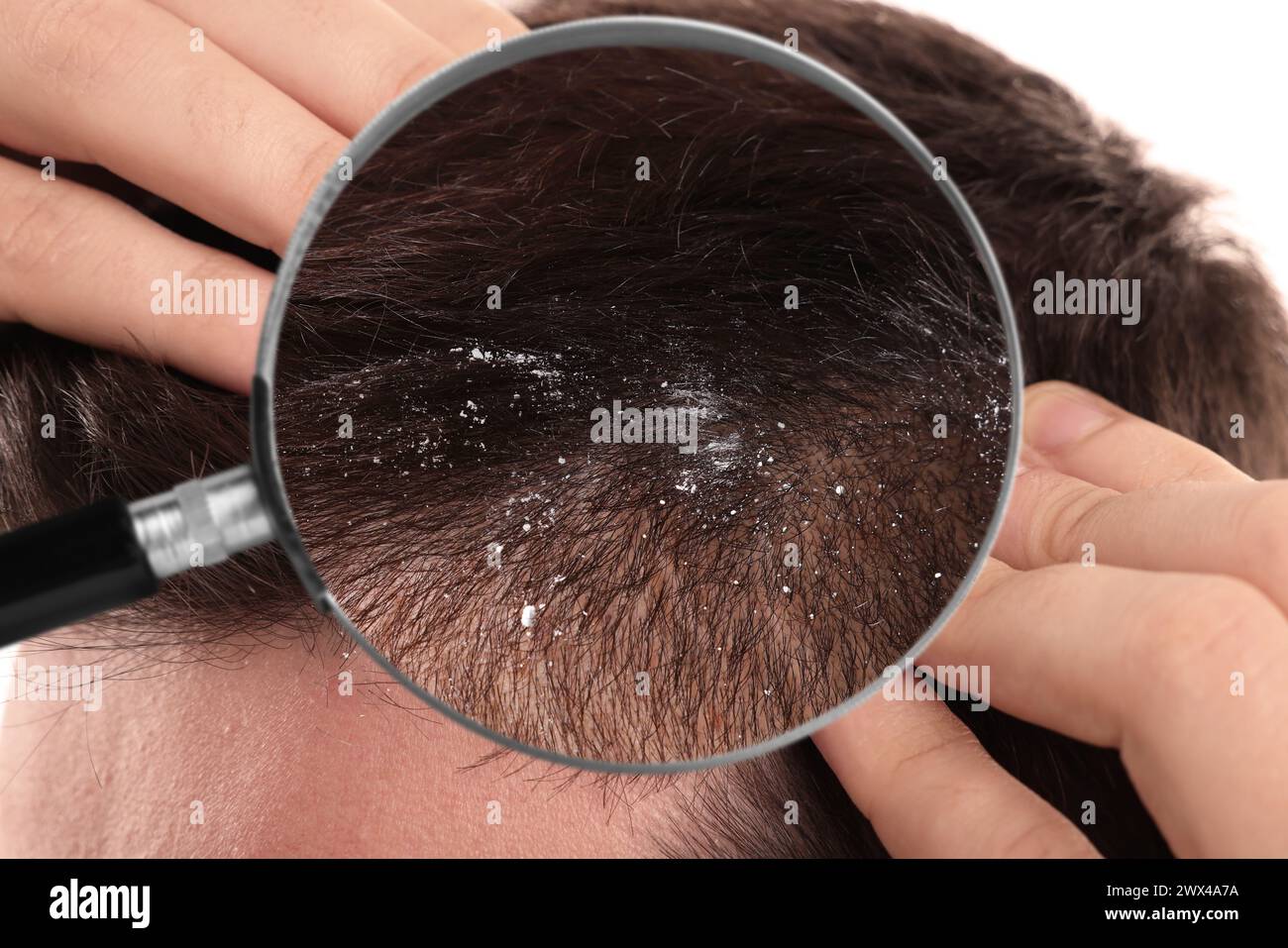 Man suffering from dandruff, closeup. View through magnifying glass on ...