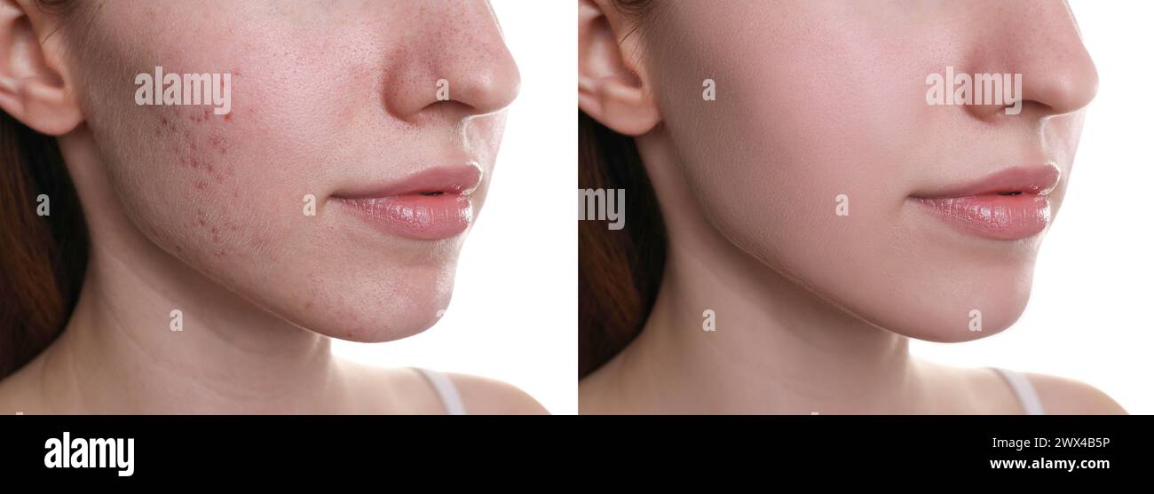 Acne problem. Young woman before and after treatment on white ...