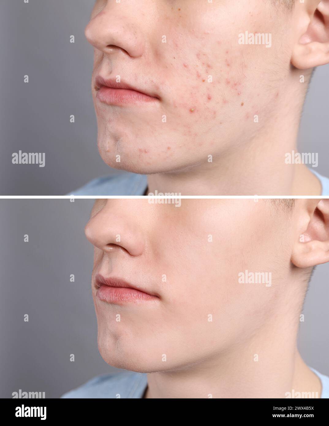 Acne problem. Young man before and after treatment on grey background ...