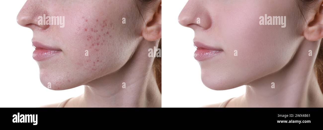 Acne problem. Young woman before and after treatment on white ...