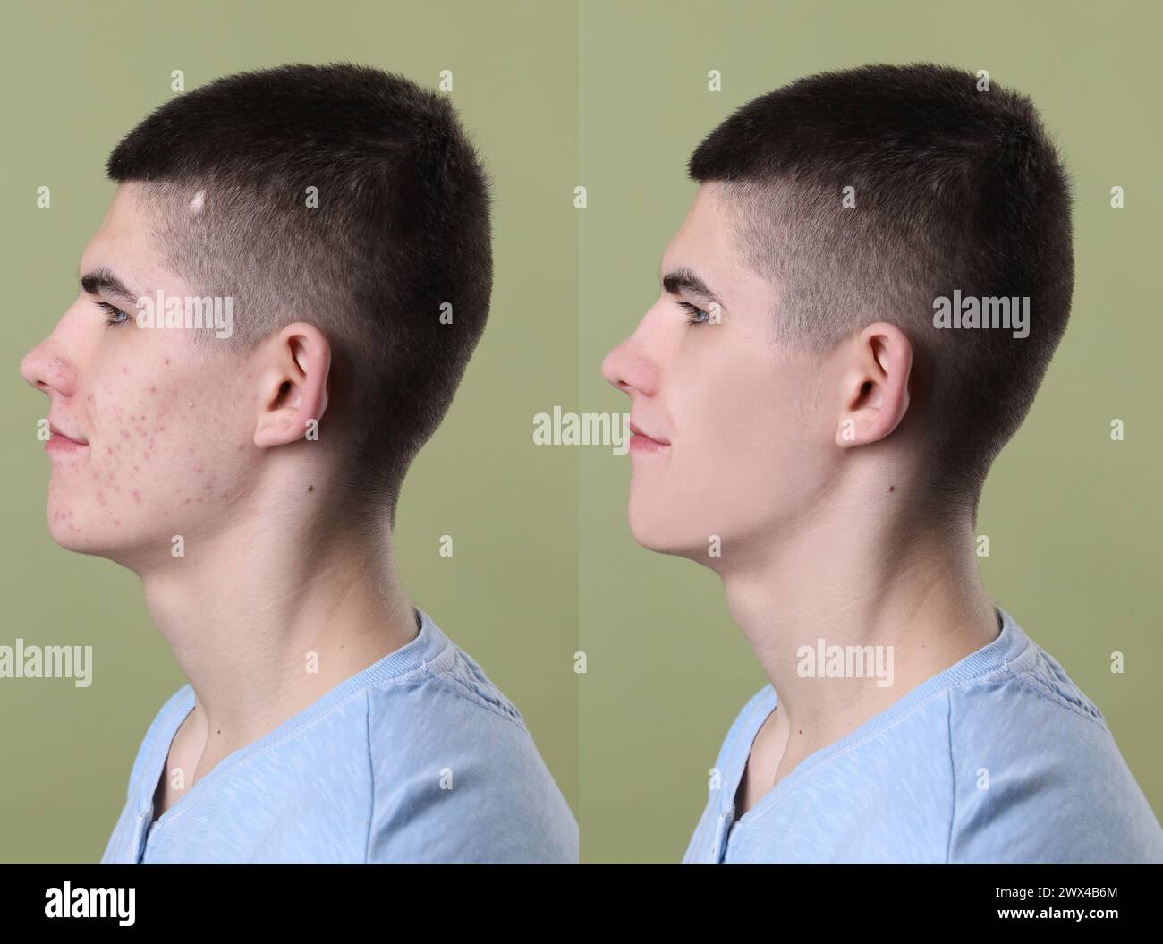 Acne problem. Young man before and after treatment on green background ...