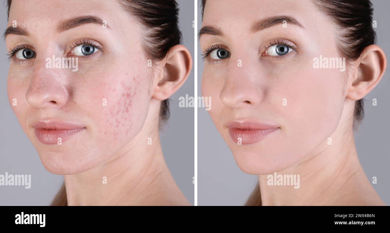 Acne problem. Young woman before and after treatment on grey background ...