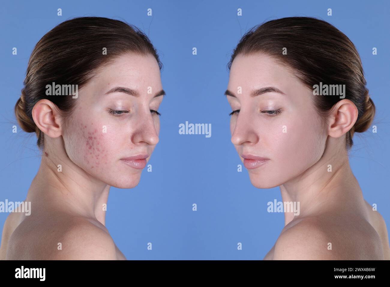 Acne problem. Young woman before and after treatment on blue background ...