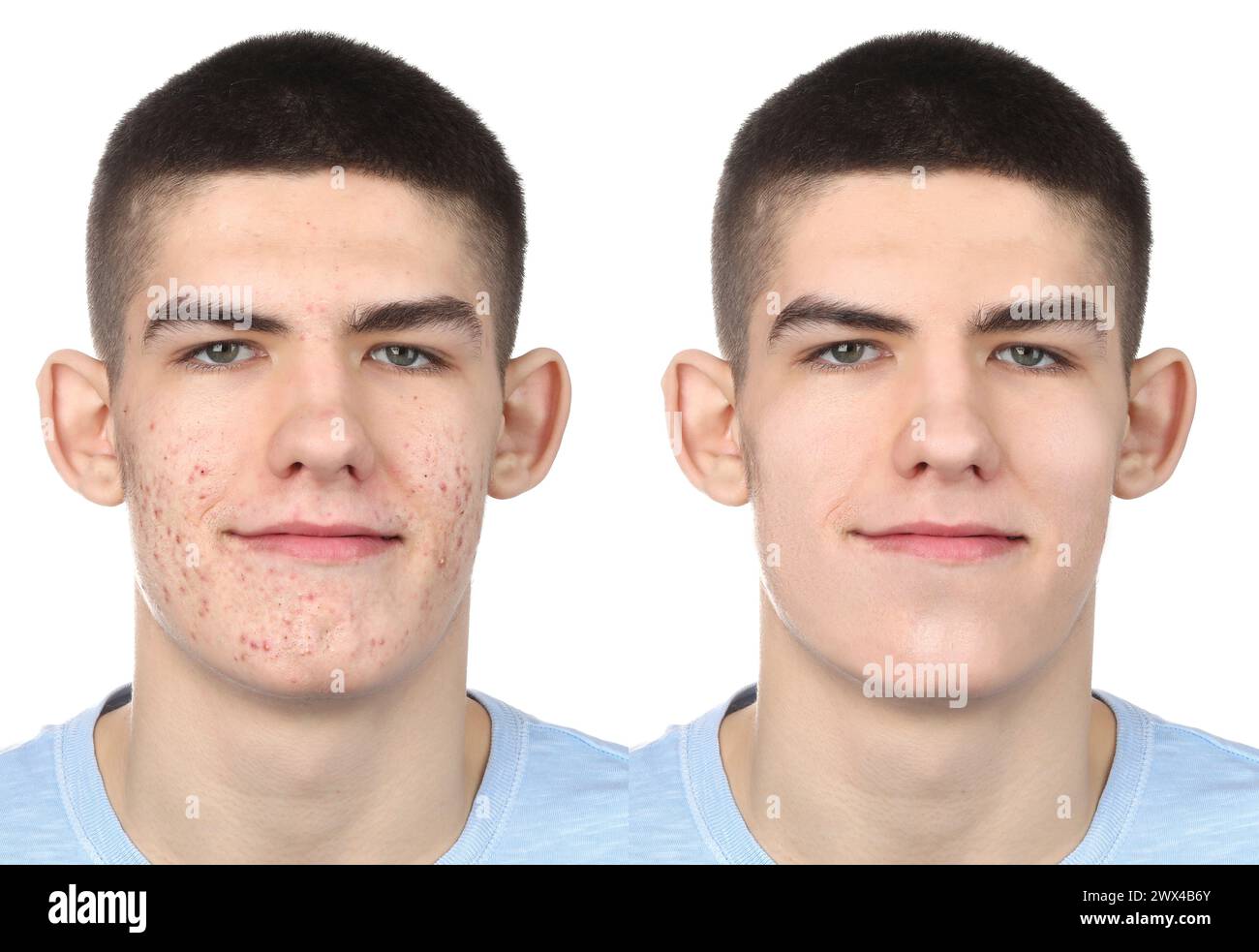 Acne problem. Young man before and after treatment on white background ...