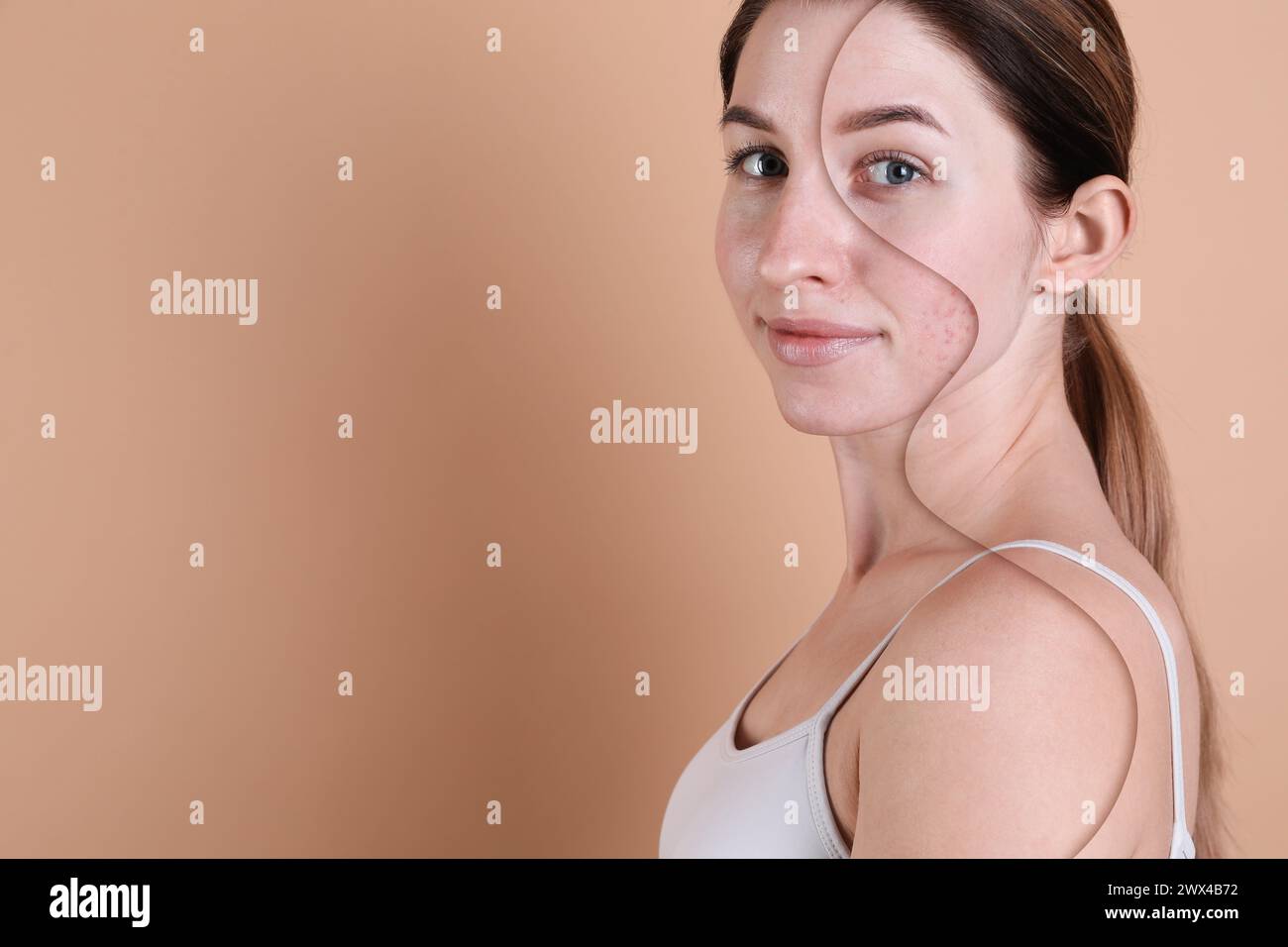 Acne problem, collage. Woman before and after treatment on beige ...
