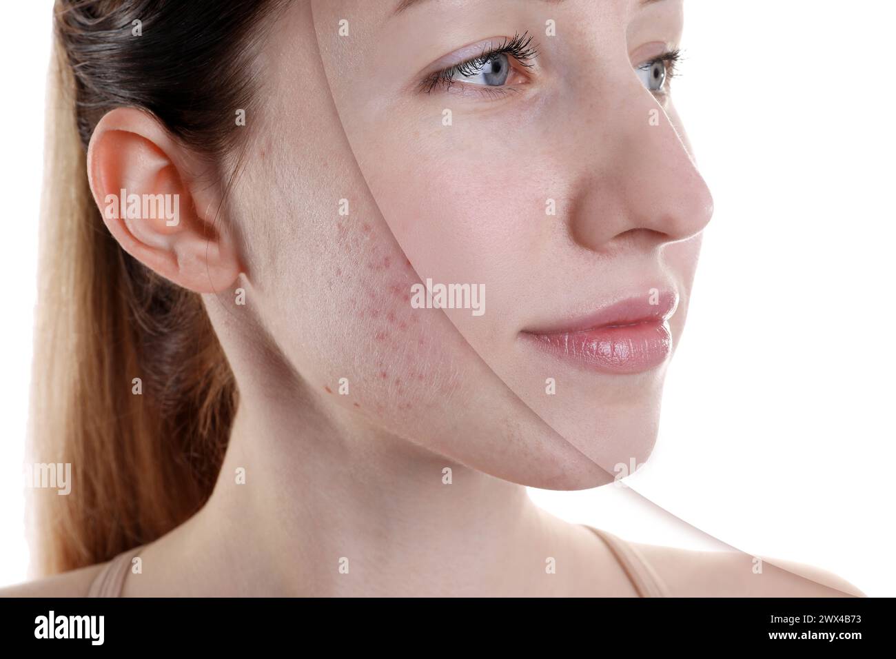 Acne problem, collage. Photo of woman divided into halves before and ...