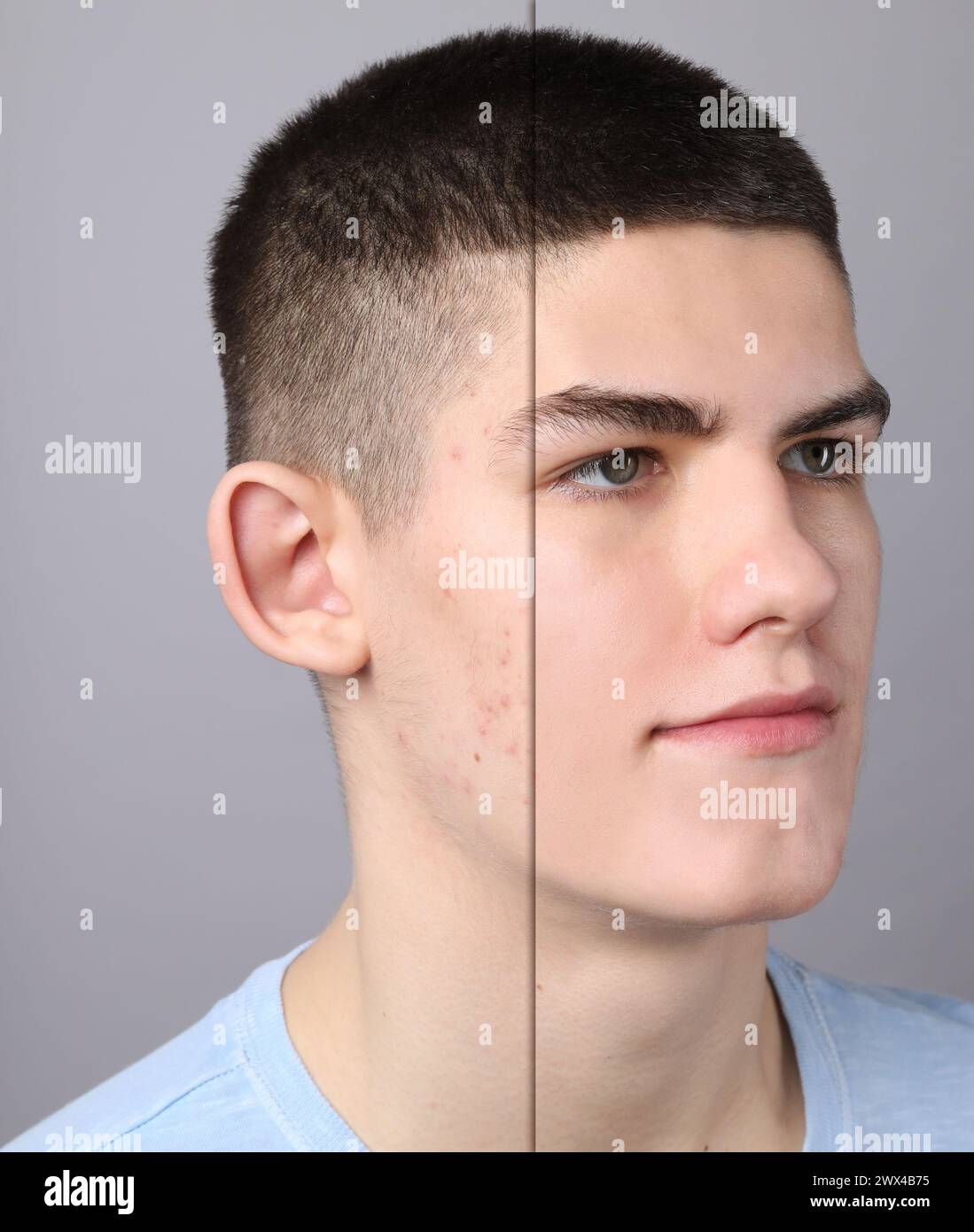 Acne problem, collage. Photo of man divided into halves before and ...