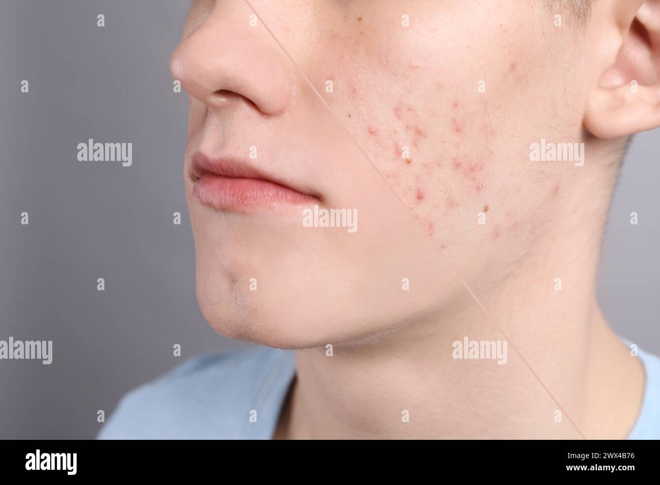 Acne problem, collage. Photo of man divided into halves before and ...