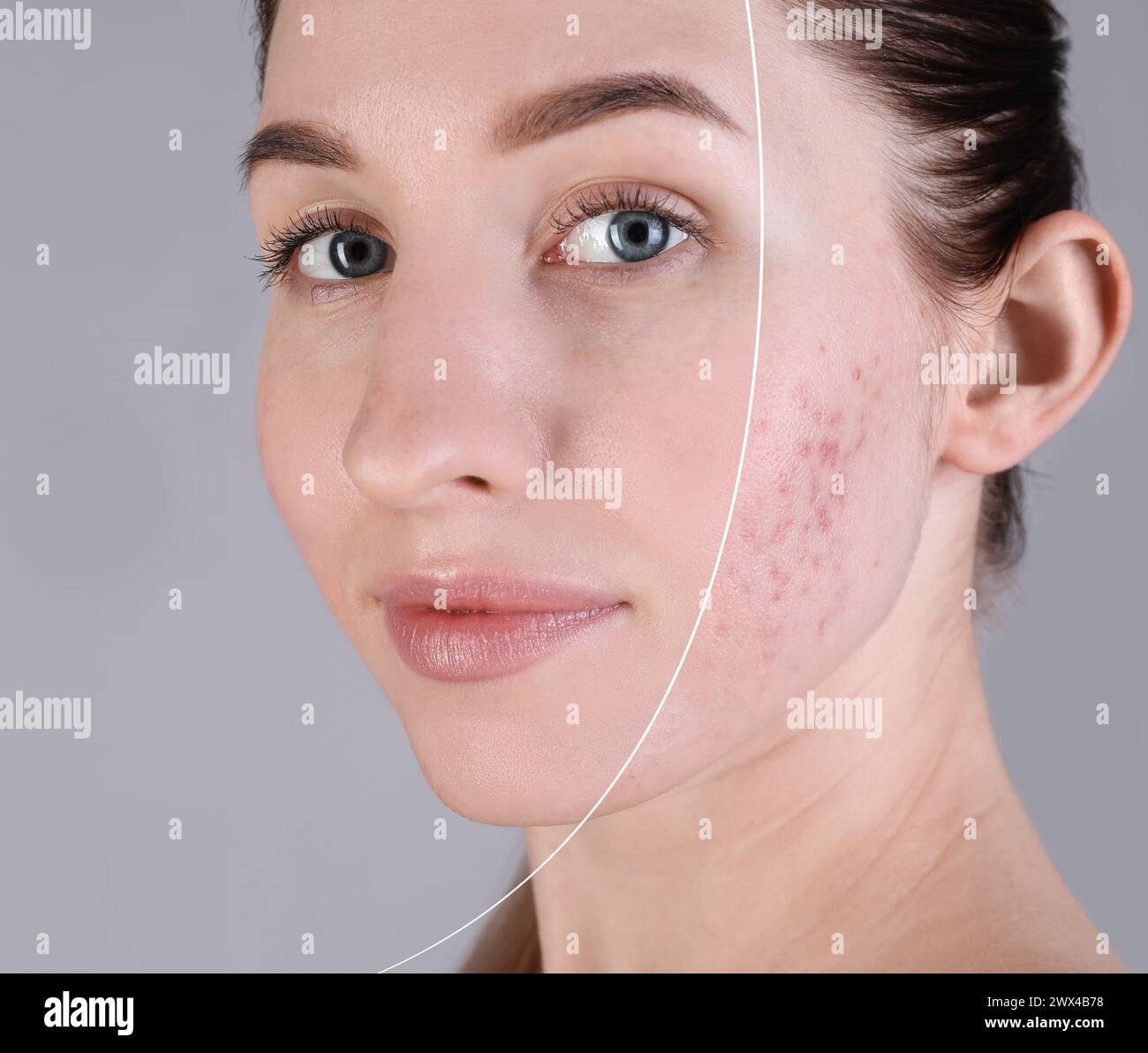 Acne problem, collage. Woman before and after treatment on grey background Stock Photo - Alamy