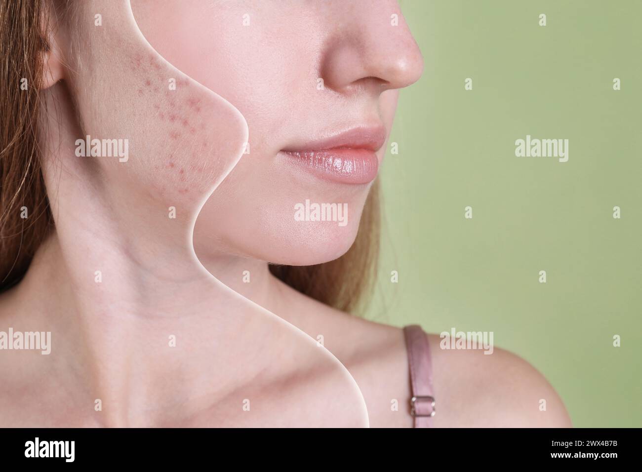 Acne problem, collage. Woman before and after treatment on green ...