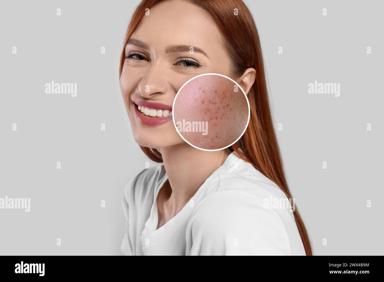 Woman skin rash happy hi-res stock photography and images - Alamy