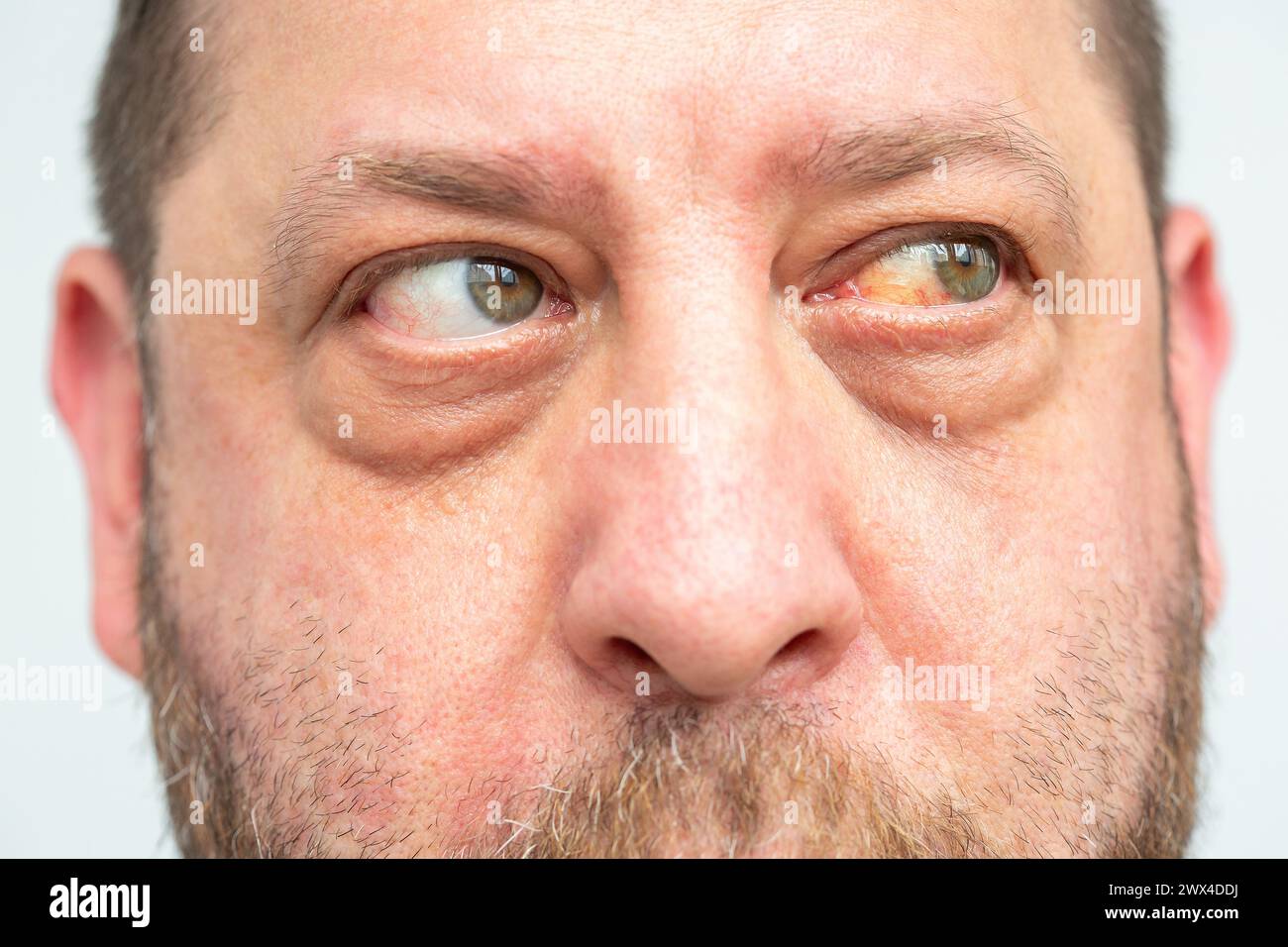 Close-up of a man's face: visible hemorrhage and redness of the eye ...