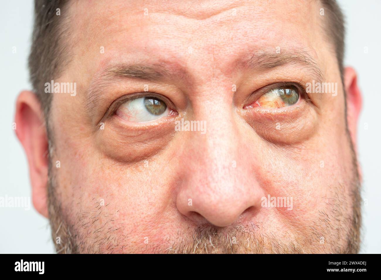 Close-up of a man's face: visible hemorrhage and redness of the eye ...