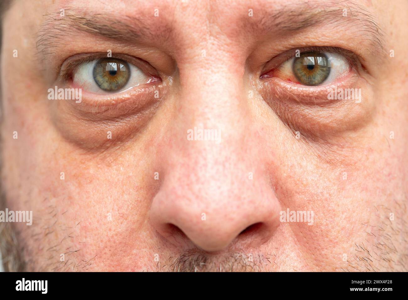 Redness of the eye, possible consequences of capillary rupture or ...