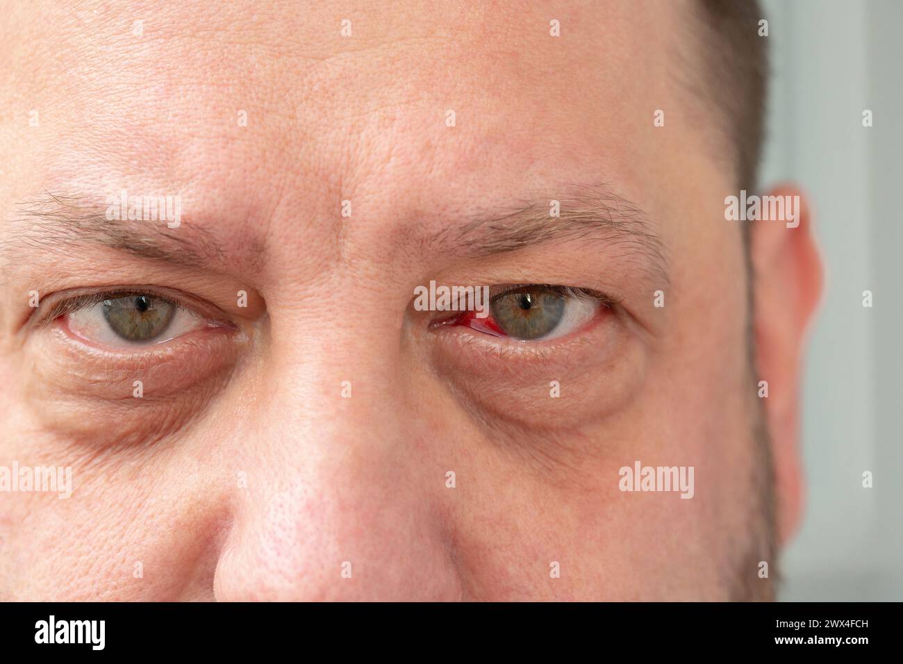 Hemorrhage due to capillary rupture in the man's eye. Detailed image of ...
