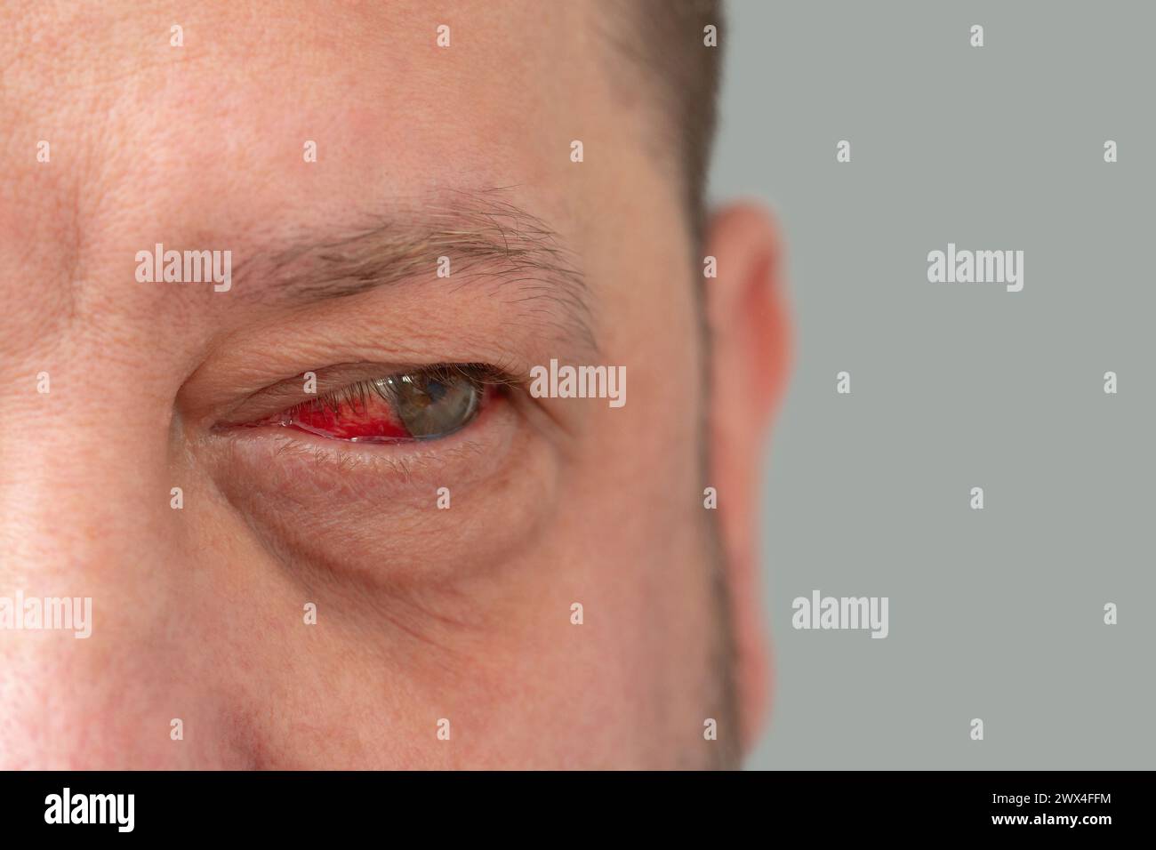Hemorrhage due to capillary rupture in the man's eye. Detailed image of ...