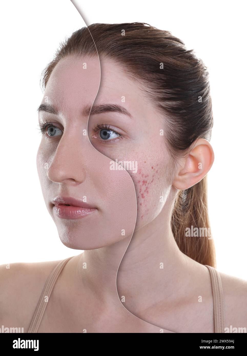 Acne problem, collage. Photo of woman divided into halves before and ...