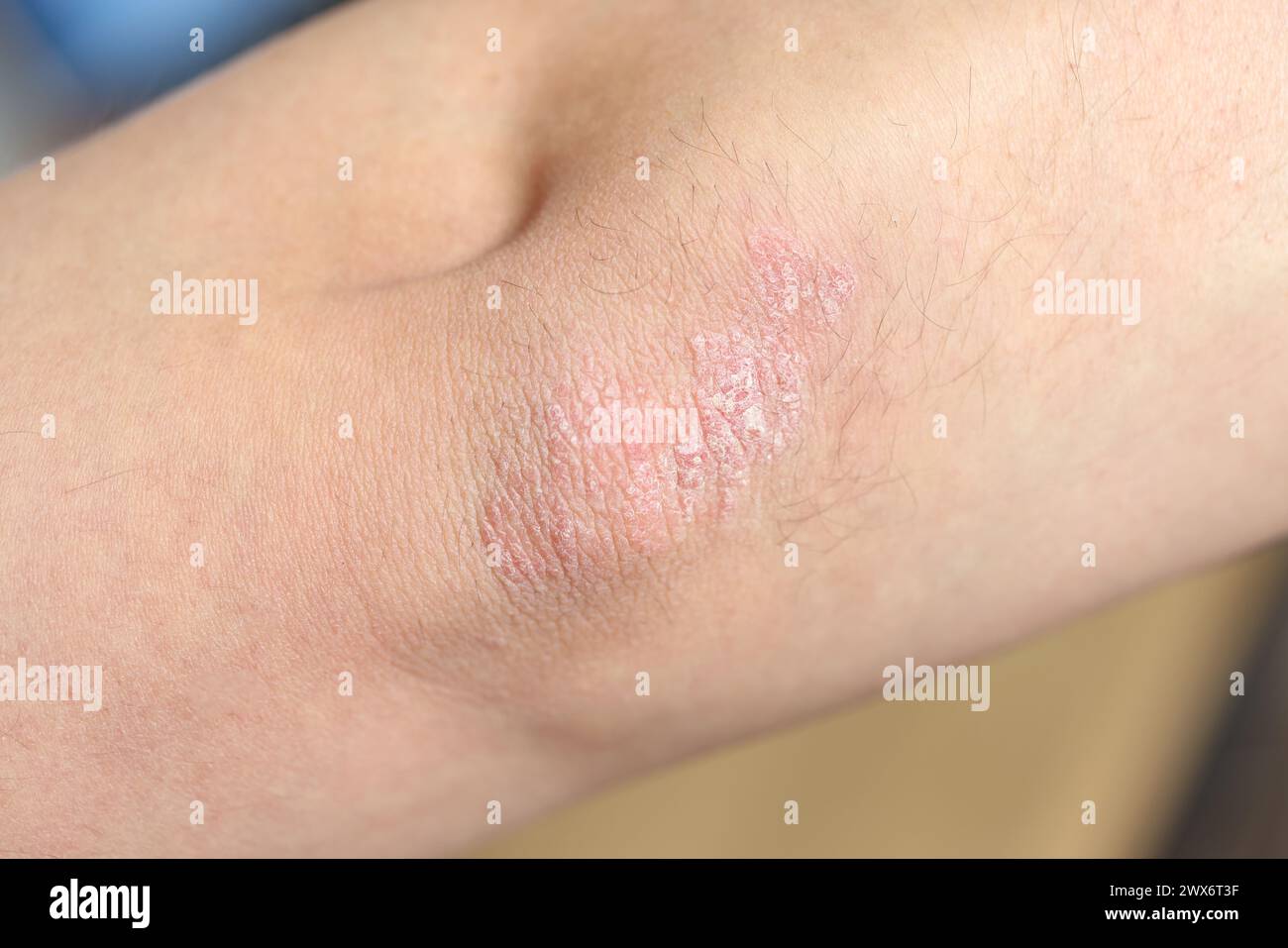 Elbow rash man hi-res stock photography and images - Alamy