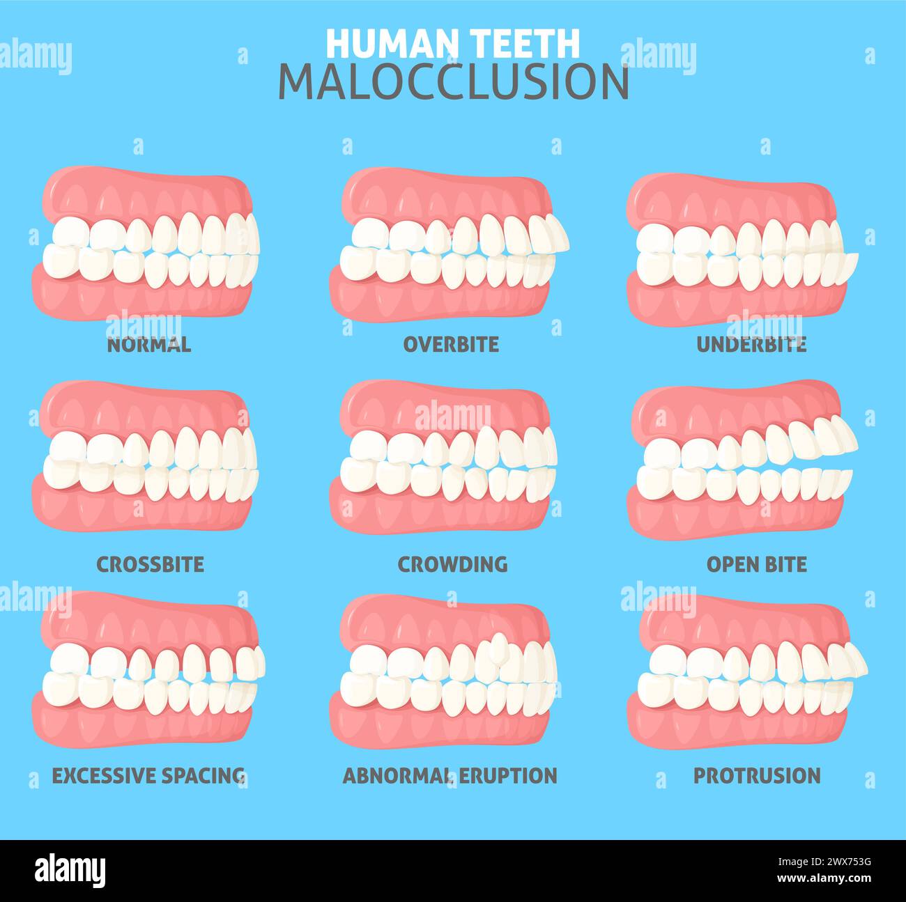 Malocclusion types side view dentist medical poster Stock Vector Image ...