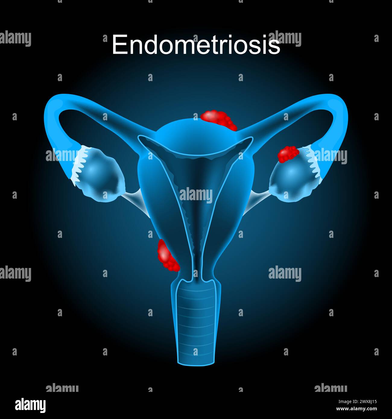 Endometriosis. Cross section of a human uterus with Endometrial tissue ...