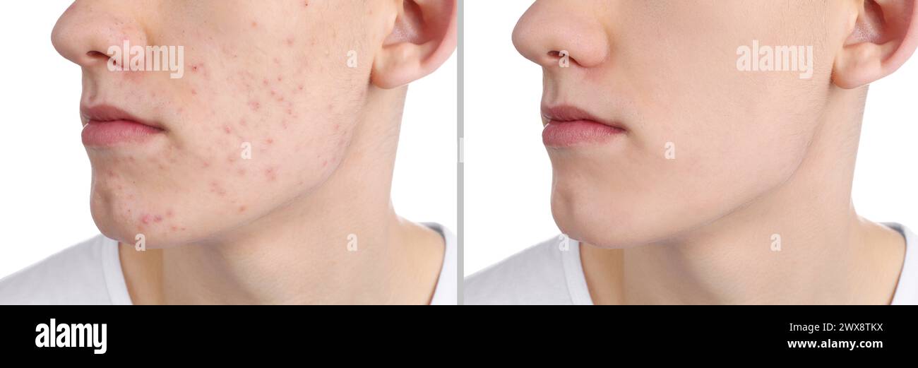 Acne problem. Young man before and after treatment on white background ...