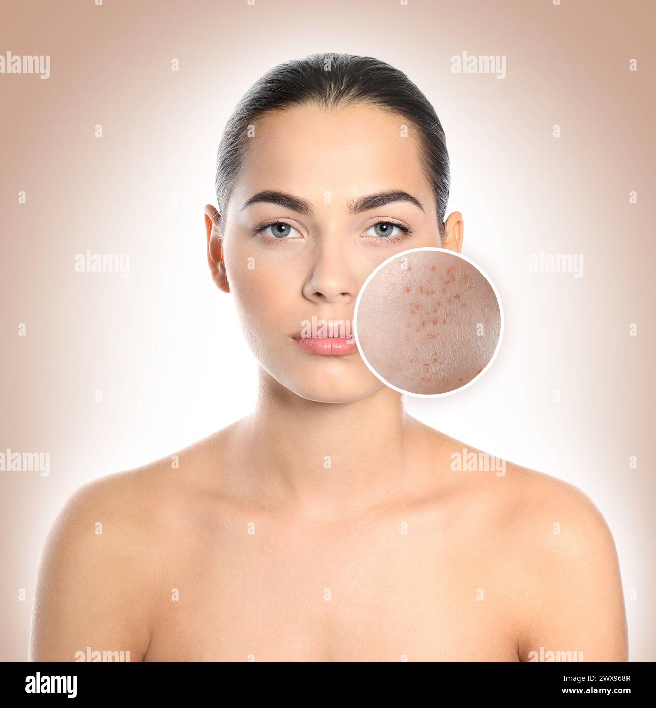 Woman with acne on her face on beige gradient background. Zoomed area ...