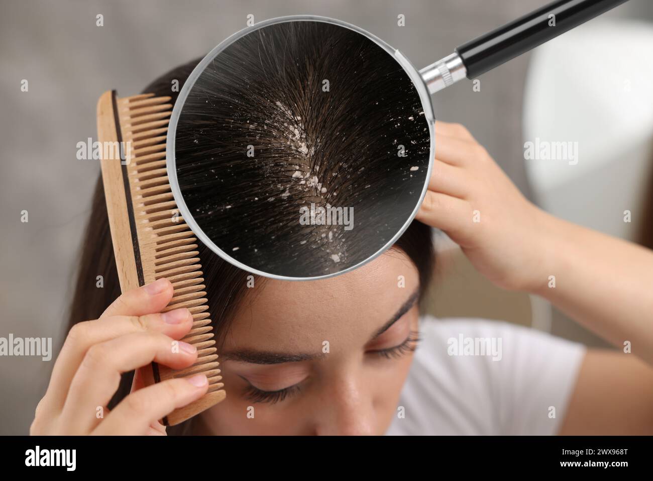 Woman suffering from dandruff on blurred background, closeup. View ...