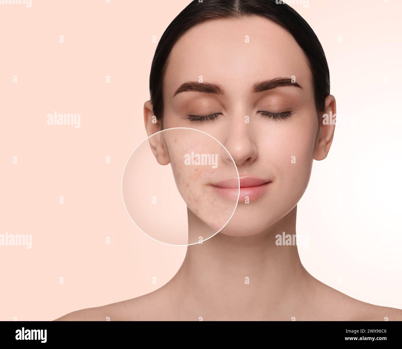 Woman with acne on her face on beige background. Zoomed area showing ...