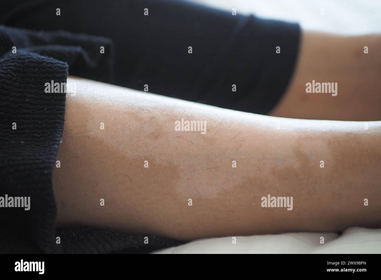 Vitiligo skin condition hi-res stock photography and images - Alamy