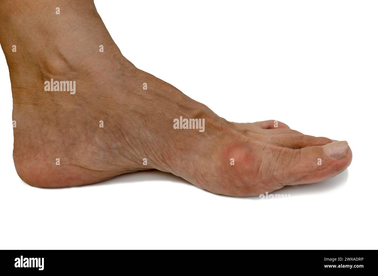 Left leg with painful swollen inflammation of gout,initial stage Stock ...