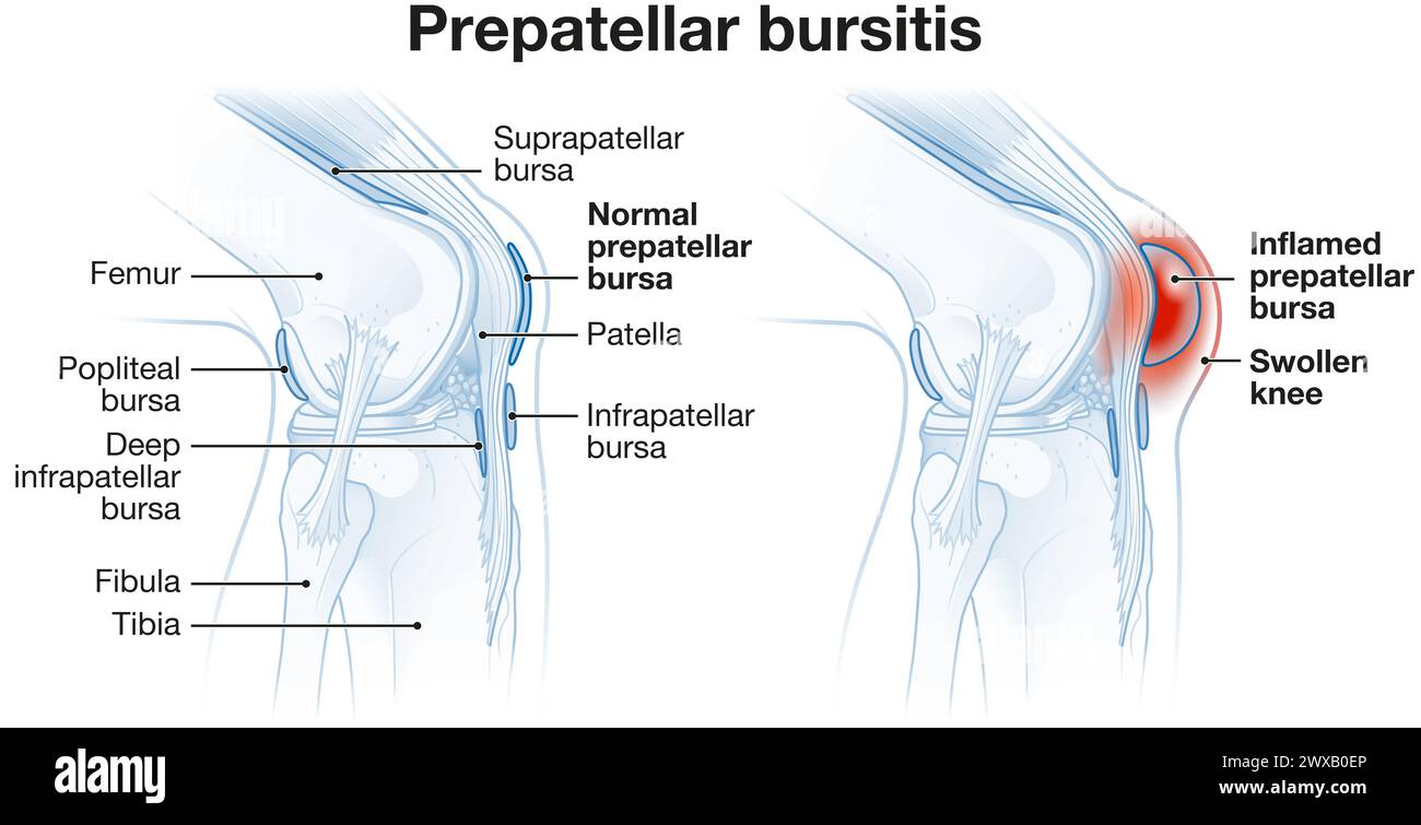 Prepatellar bursitis, inflammation of the bursa in front of the kneecap ...