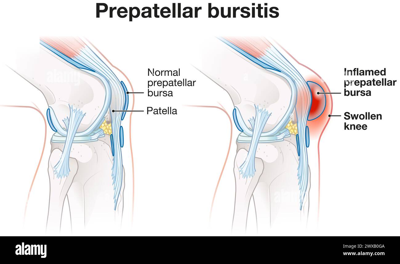 Prepatellar bursitis, inflammation of the bursa in front of the kneecap, causes swelling, pain ...