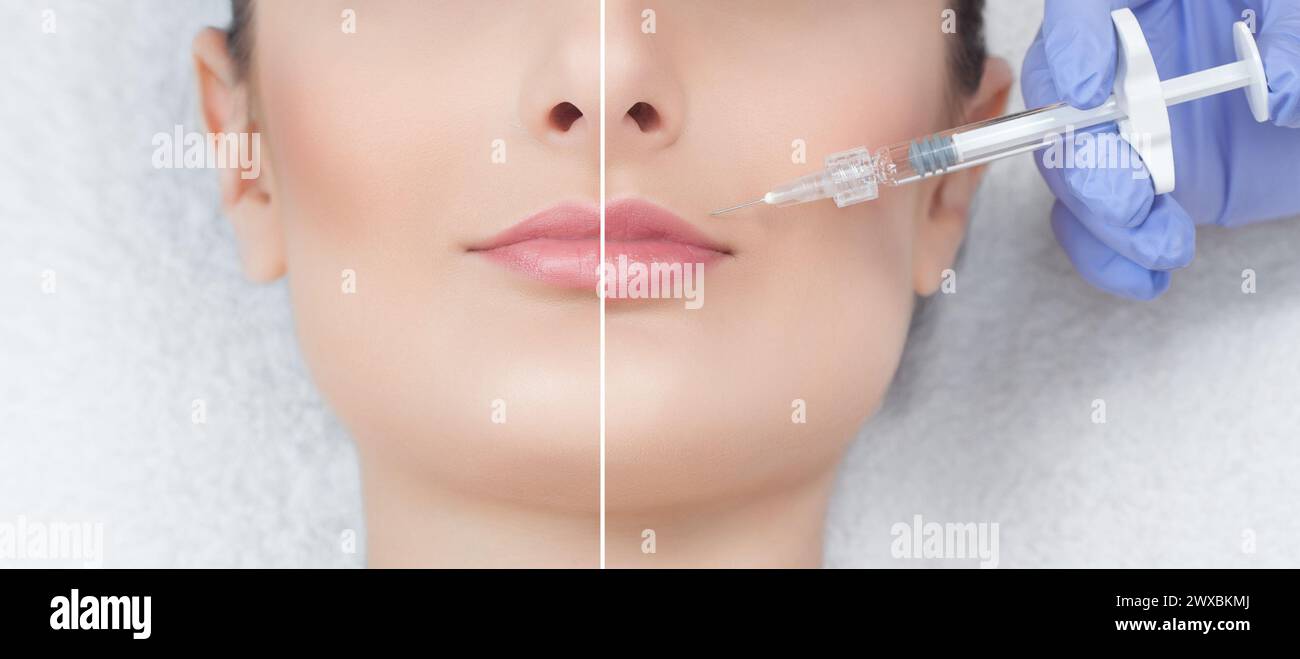 The cosmetologist makes injections of botulinum toxin in the lips of ...