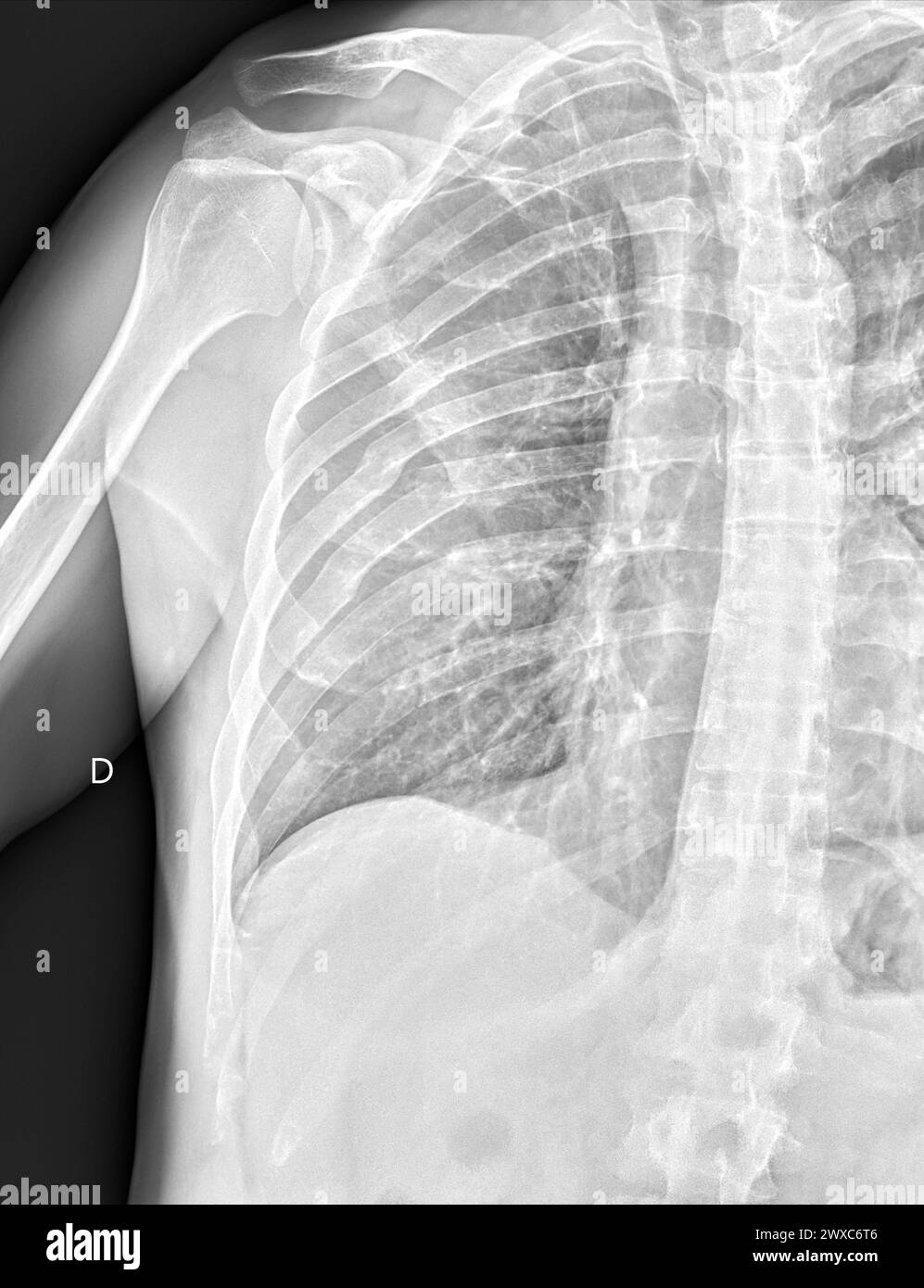 Xray of a human chest with broken ribs Stock Photo - Alamy