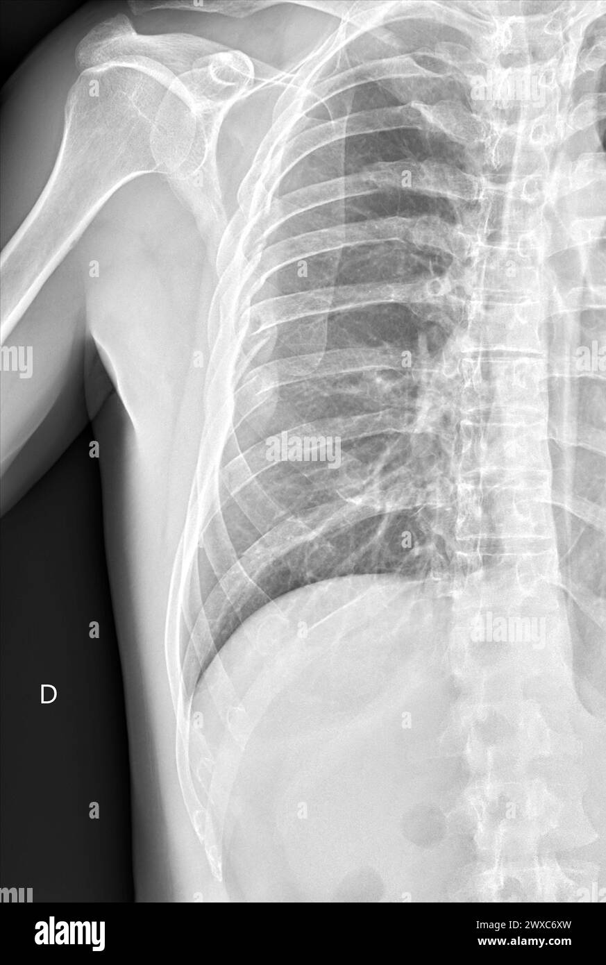 Xray of a human chest with broken ribs Stock Photo - Alamy