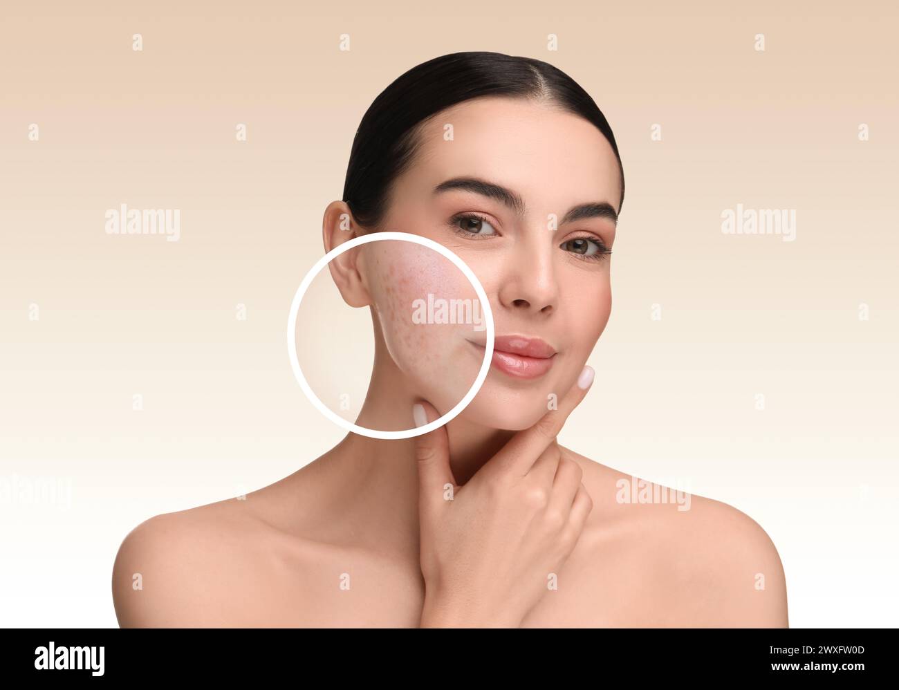 Woman with acne on her face on beige background. Zoomed area showing ...