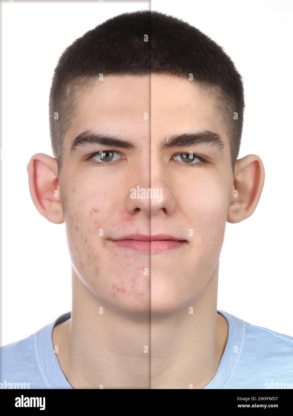 Acne problem, collage. Photo of man divided into halves before and ...