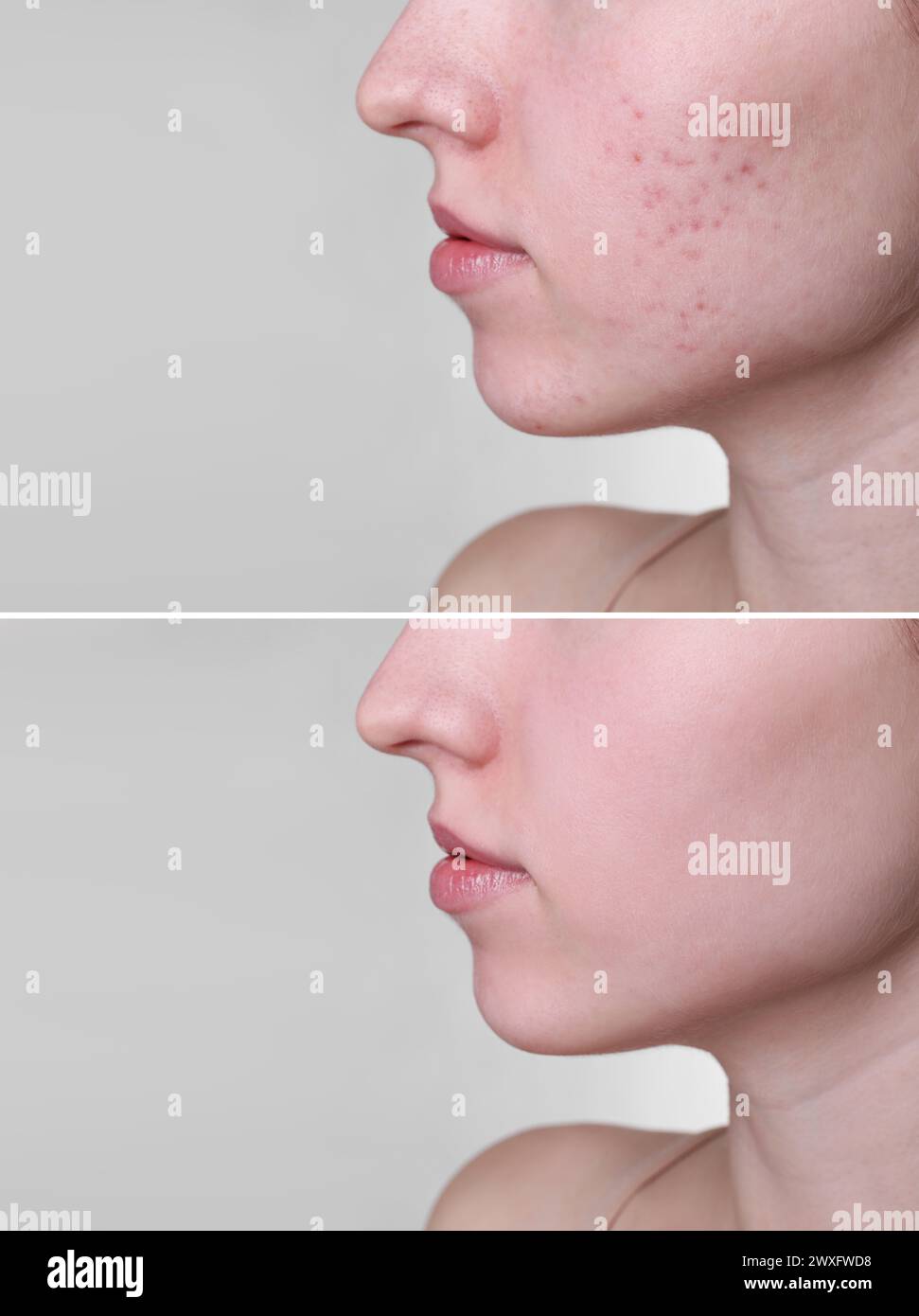 Acne problem. Young woman before and after treatment on light grey ...