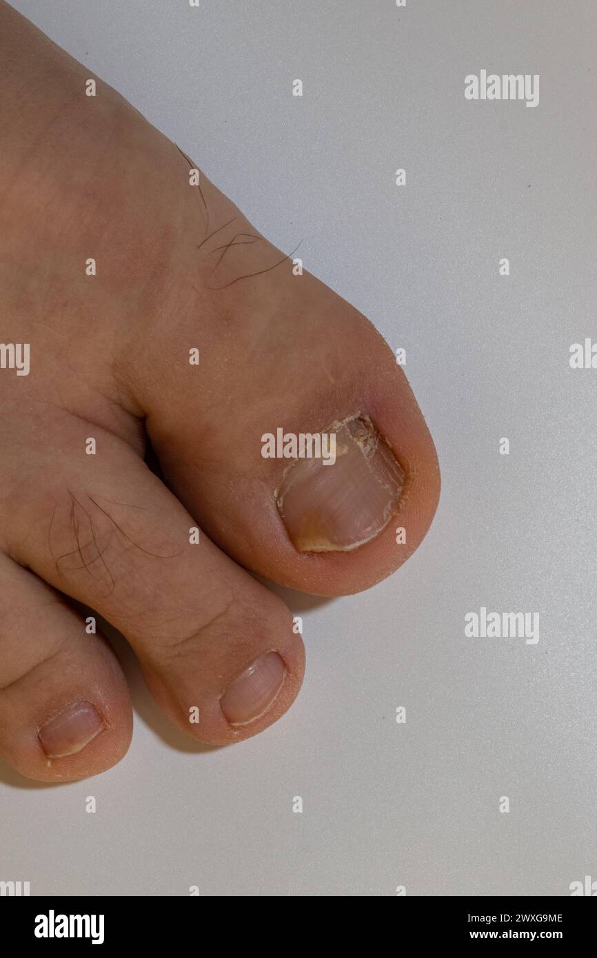 fungal nail infection Onychomycosis dry coarse skin of the legs Stock ...