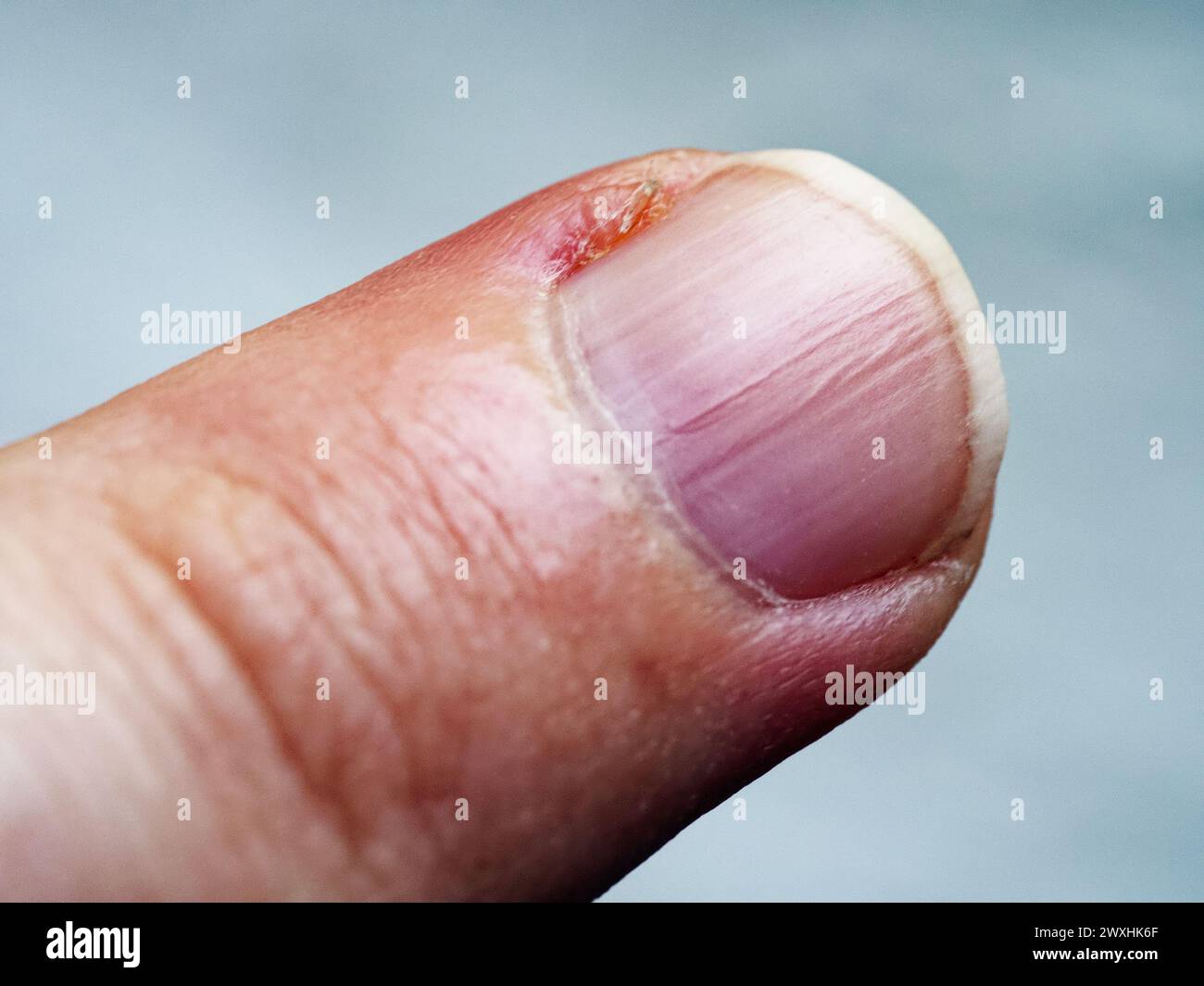 Skin bruise texture hi-res stock photography and images - Alamy
