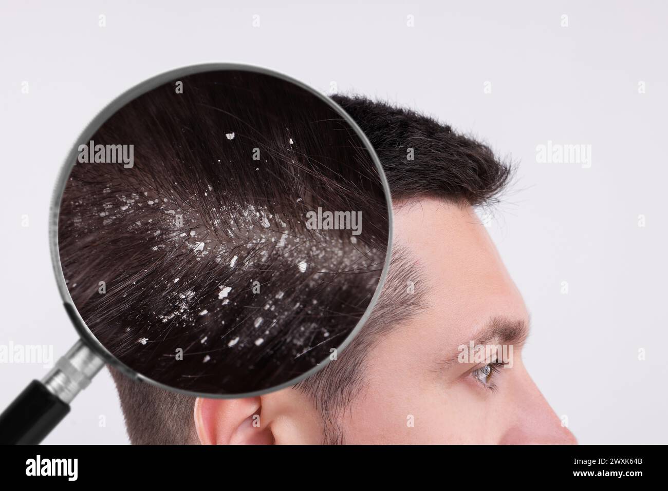 Man suffering from dandruff on white background, closeup. View through ...
