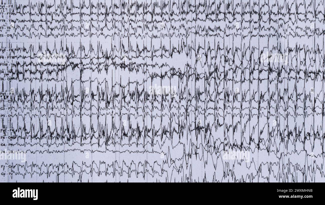 Imaging of ictal EEG recording in epilepsy patient during monitoring ... Imaging of ictal EEG recording in epilepsy patient during monitoring ...
