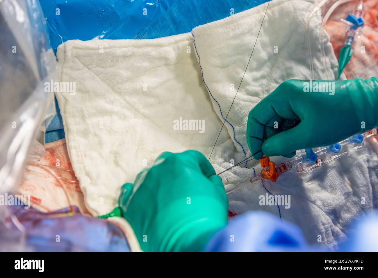 Heart stent placement process in operating room. Heart doctor inserting ...