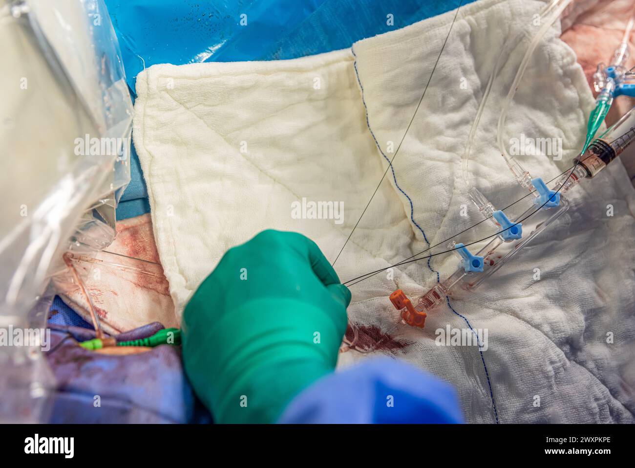 Heart stent placement process in operating room. Heart doctor inserting ...