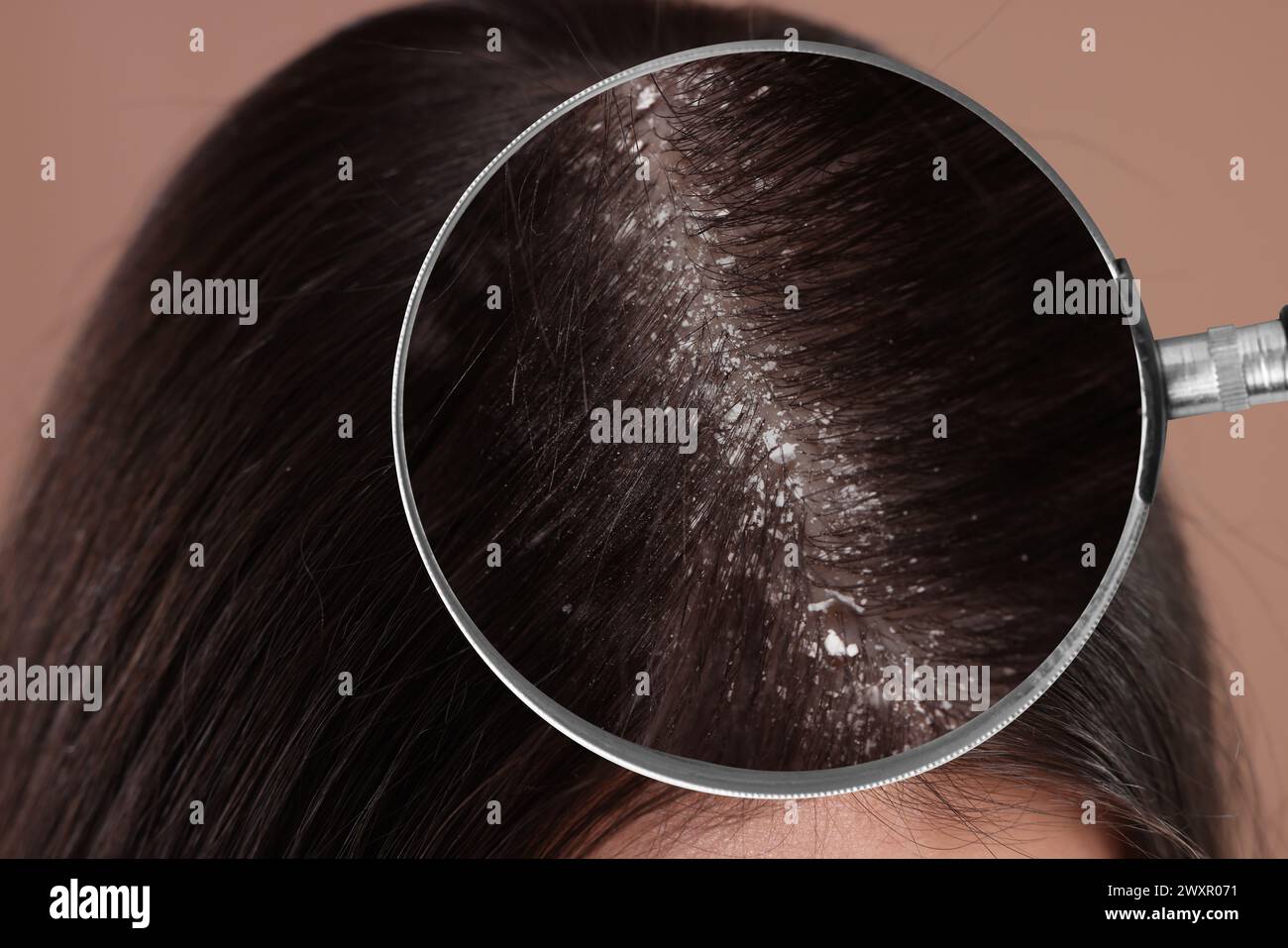 Woman suffering from dandruff on pale brown background, closeup. View ...